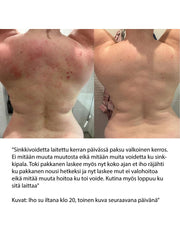 Miten erottaa atooppinen ihottuma ja TSW iho (eli kortisonivoidehoidon ...