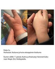 Miten erottaa atooppinen ihottuma ja TSW iho (eli kortisonivoidehoidon ...